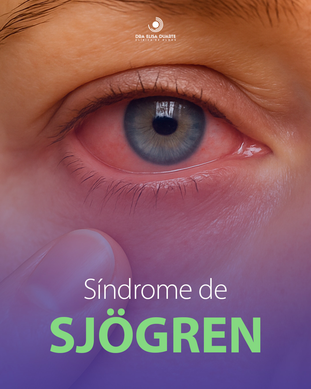 Síndrome de Sjögren - Dra. Elisa Duarte - Oftalmologista e Cirurgia de ...