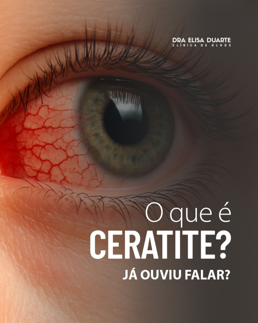 O que é Ceratite? - Dra. Elisa Duarte - Oftalmologista e Cirurgia de ...